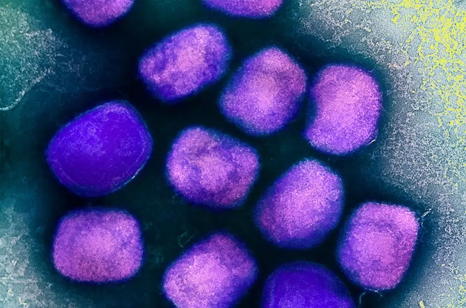 Two new m-pox cases discovered in Minnesota; first new cases since ...