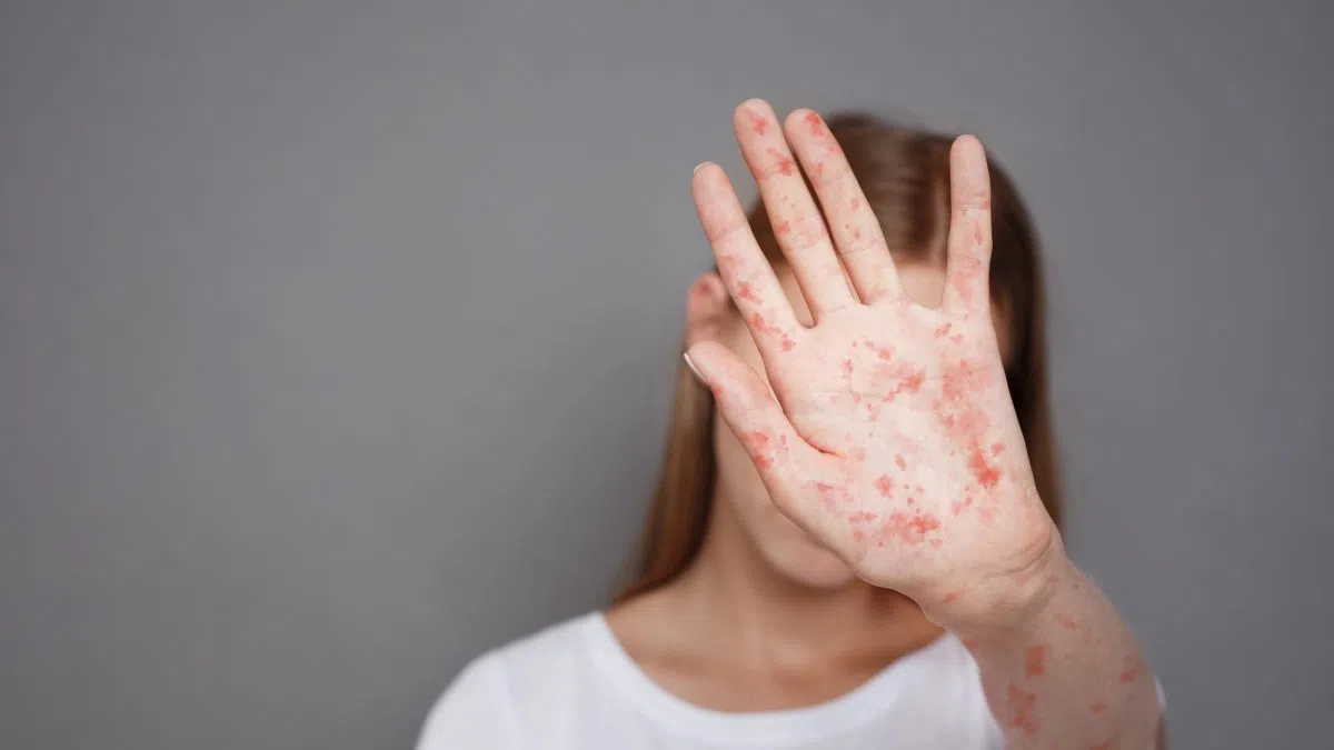 Measles Confirmed In Huron-Perth | Bayshore Broadcasting News Centre