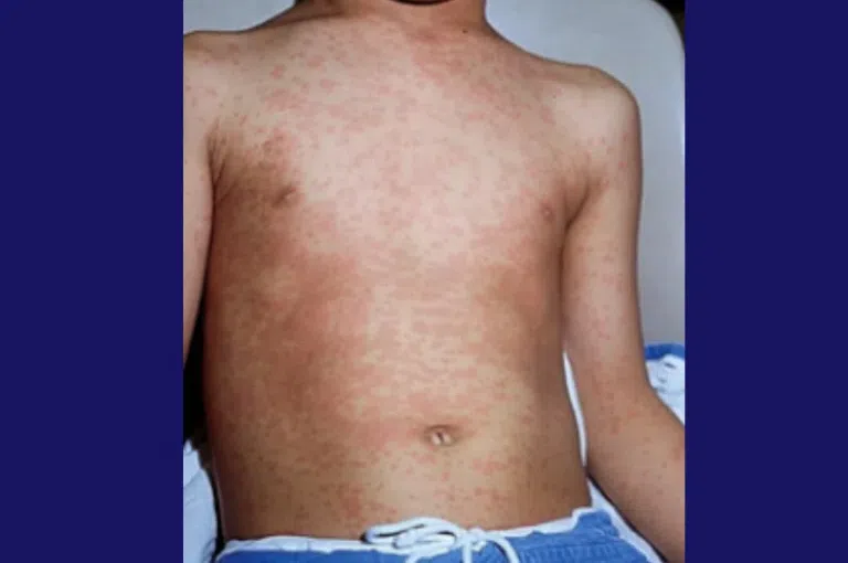 Warning issued for measles exposure risk at several sites in Saskatoon ...